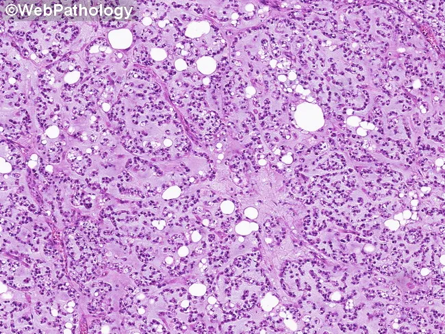 Chondroid Lipoma : Differential Diagnosis