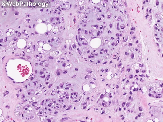 Chondroid Lipoma : Prognosis
