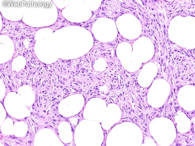 Spindle Cell Lipoma : Introduction
