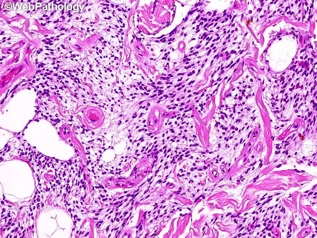 Spindle Cell Lipoma : Microscopic