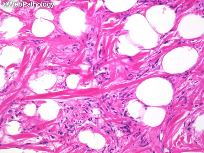 Spindle Cell Lipoma : Collagen Bundles