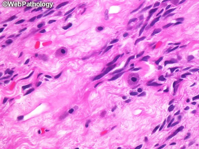 Spindle Cell Lipoma : Mast Cells