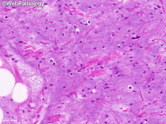 Spindle Cell Lipoma : Myxoid Stroma