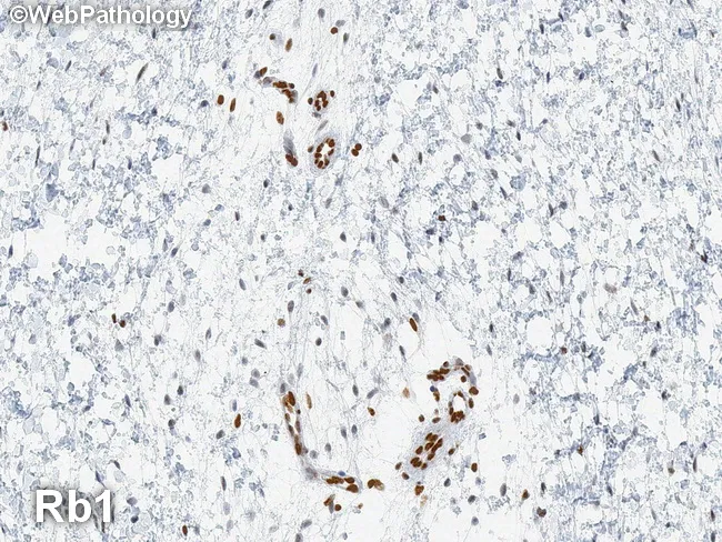 Spindle Cell Lipoma : RB1 Deletion