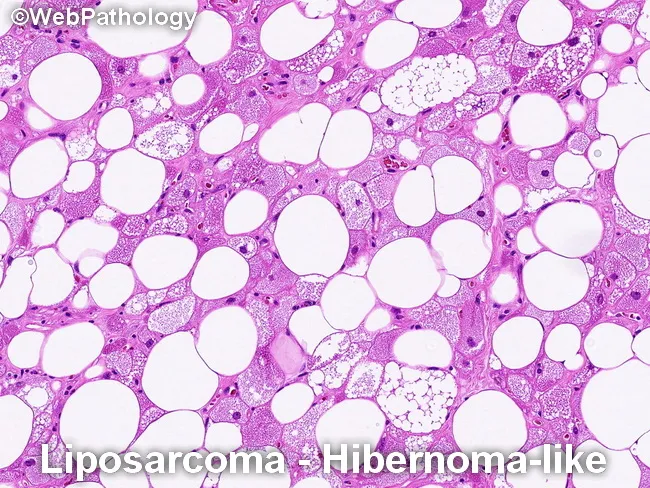 Hibernoma : Differential Diagnosis