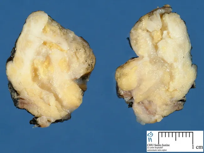 Lipoblastoma : Gross Pathology