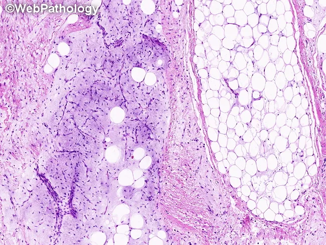 Lipoblastoma : Microscopic Features