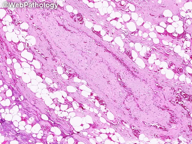 Neural Fibrolipoma : Microscopic Features