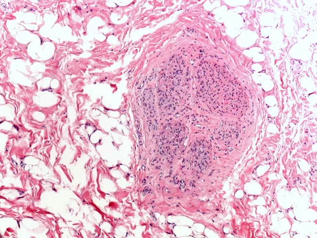 Neural Fibrolipoma : Differential Diagnosis