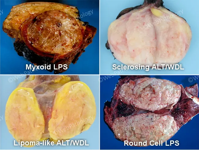 Liposarcoma : Gross Morphology