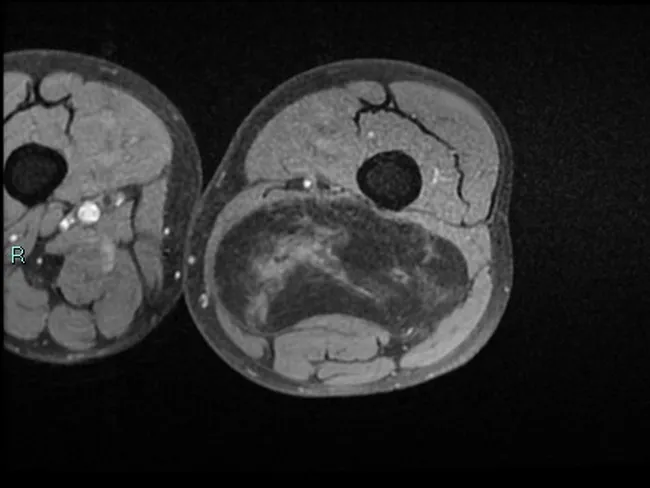 Atypical Lipomatous Tumor/Well-Diff Liposarcoma : Imaging