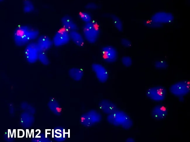 Atypical Lipomatous Tumor/Well-Diff Liposarcoma : MDM2 FISH