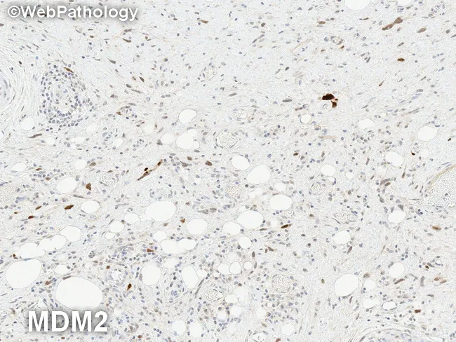 Atypical Lipomatous Tumor/Well-Diff Liposarcoma : MDM2 Amplification