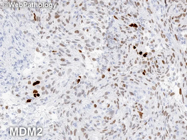 Atypical Lipomatous Tumor/Well-Diff Liposarcoma : MDM2 Amplification