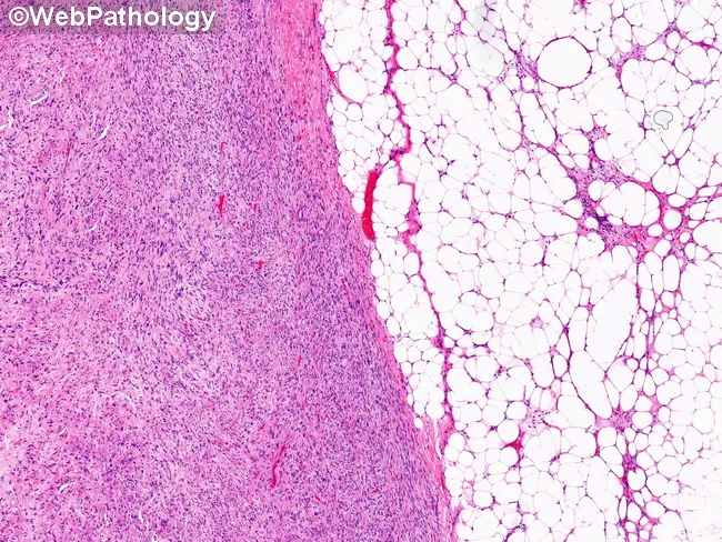 Dedifferentiated Liposarcoma : Introduction