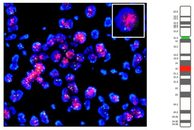 Dedifferentiated Liposarcoma : MDM2 Amplification
