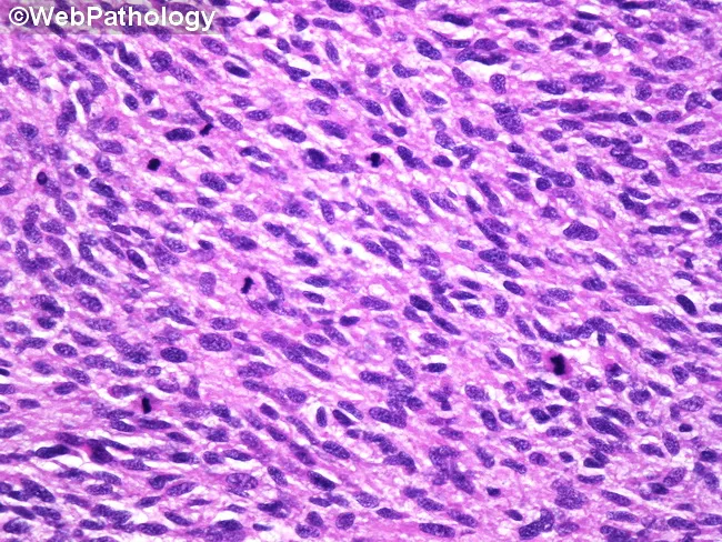 Dedifferentiated Liposarcoma : Microscopic Features