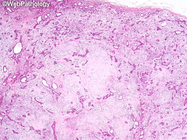 Pleomorphic Adenoma Cytology Description