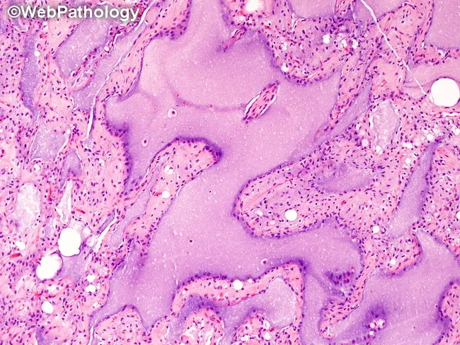 Myxoid Liposarcoma : Mucin Pools