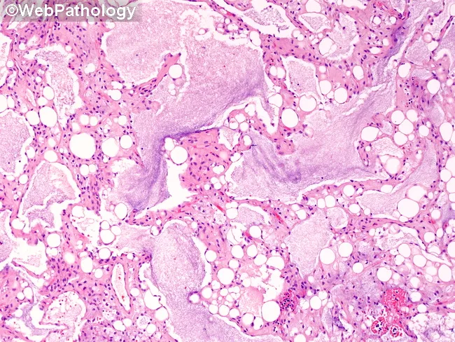 Myxoid Liposarcoma : Mucin Pools