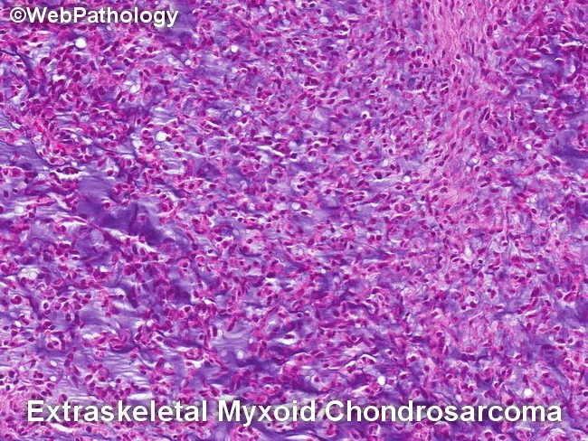 Myxoid Liposarcoma : Differential
