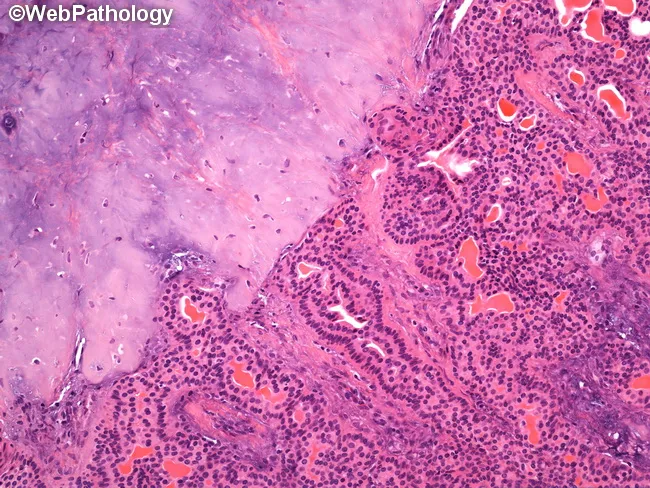 Pleomorphic Adenoma