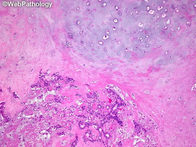 Pleomorphic Adenoma Pathology Pleomorphic Adenoma: Parotid Gland