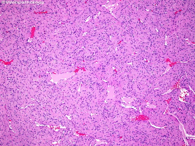 Angiomyoma (Vascular Leiomyoma)