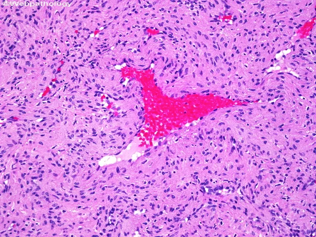 Angiomyoma (Vascular Leiomyoma)