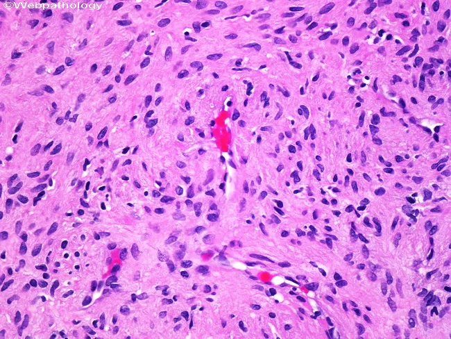 Angiomyoma (Vascular Leiomyoma)