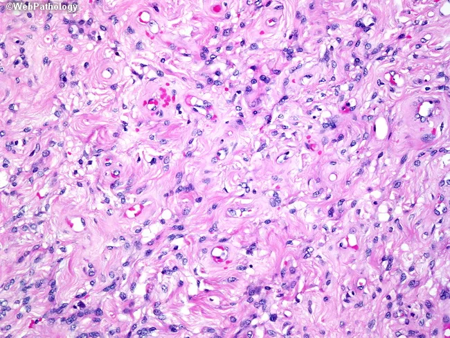 Angiomyofibroblastoma
