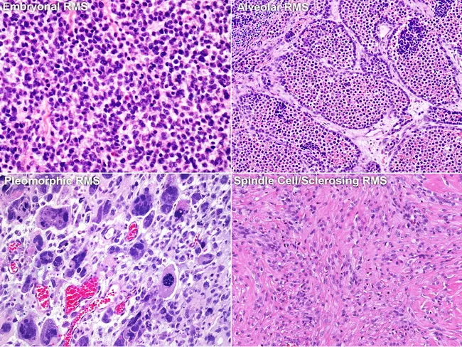 Rhabdomyosarcoma : Classification
