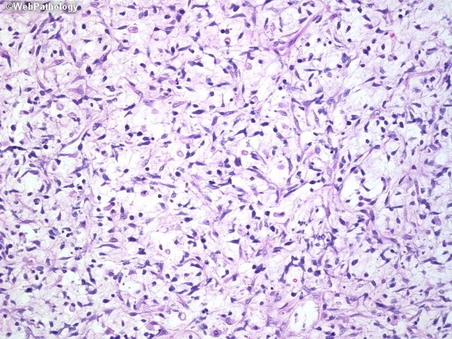 Embryonal Rhabdomyosarcoma : Microscopic