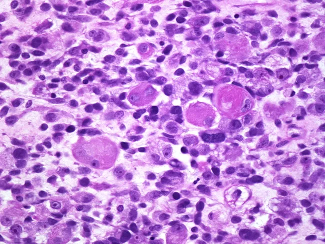 Embryonal Rhabdomyosarcoma - Rhabdomyoblasts