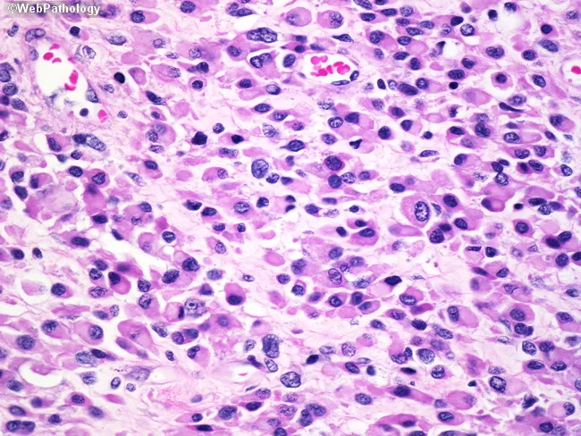 Embryonal Rhabdomyosarcoma - Rhabdomyoblasts