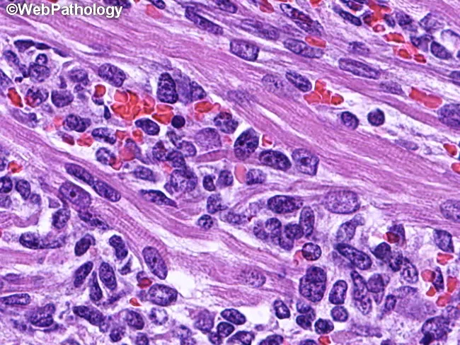 Embryonal Rhabdomyosarcoma : Cross-striations