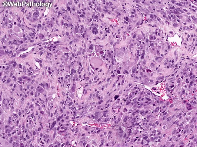 Embryonal Rhabdomyosarcoma : Anaplastic Features