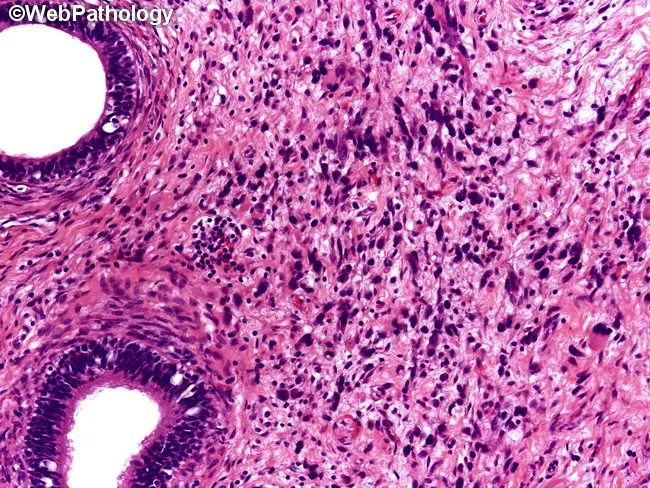 Embryonal Rhabdomyosarcoma : Molecular Genetics