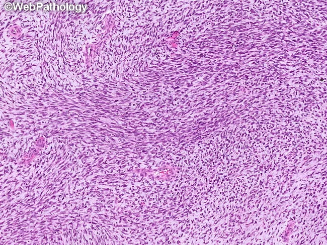 Embryonal Rhabdomyosarcoma : Orbit