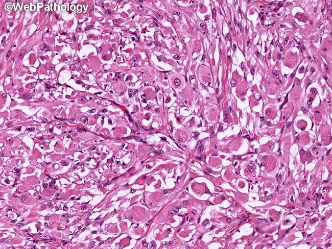 Embryonal Rhabdomyosarcoma