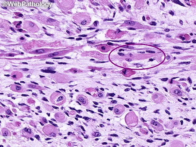 Embryonal Rhabdomyosarcoma