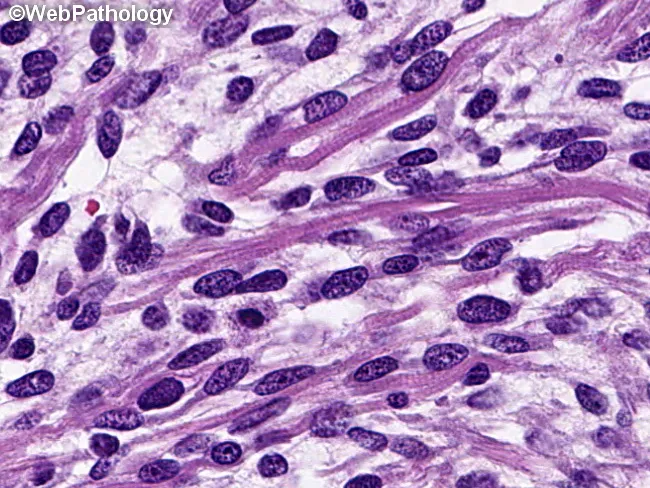 Embryonal Rhabdomyosarcoma