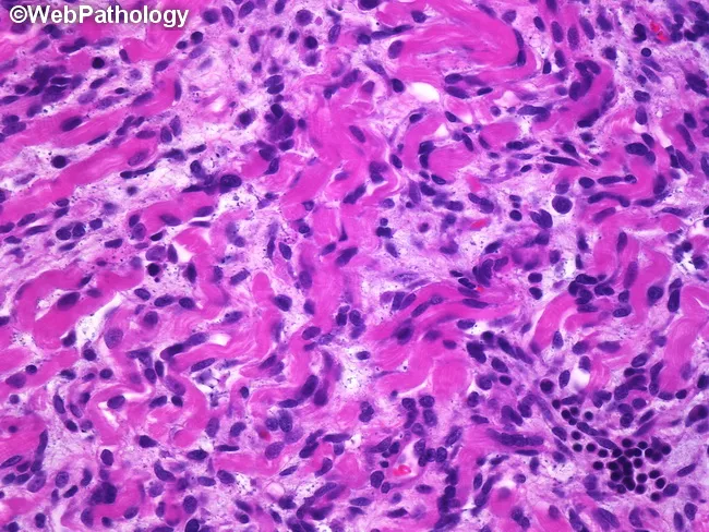 Embryonal Rhabdomyosarcoma