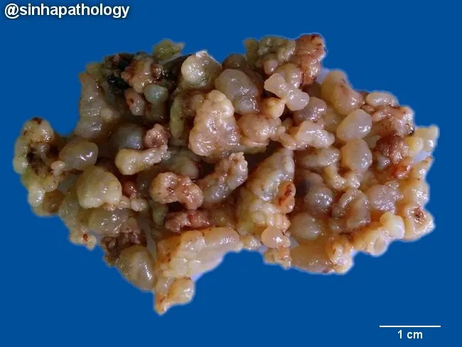 Botryoid Rhabdomyosarcoma : Gross Pathology