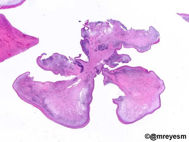 Botryoid Rhabdomyosarcoma : Microscopic