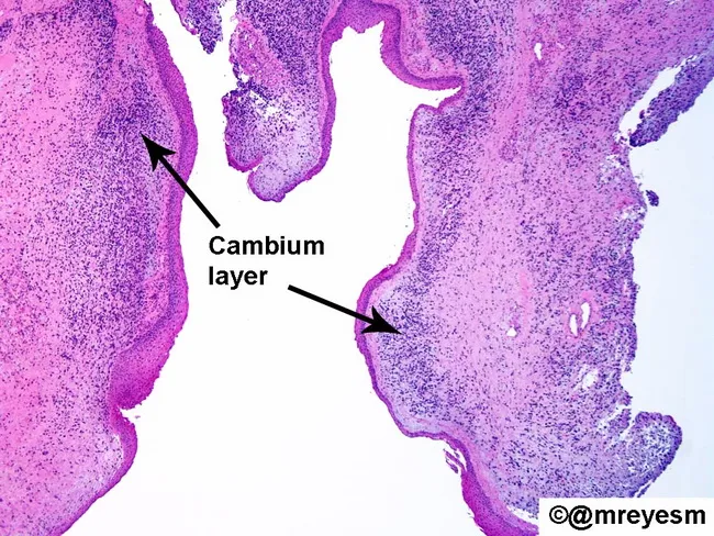Botryoid Rhabdomyosarcoma : Cambium Layer