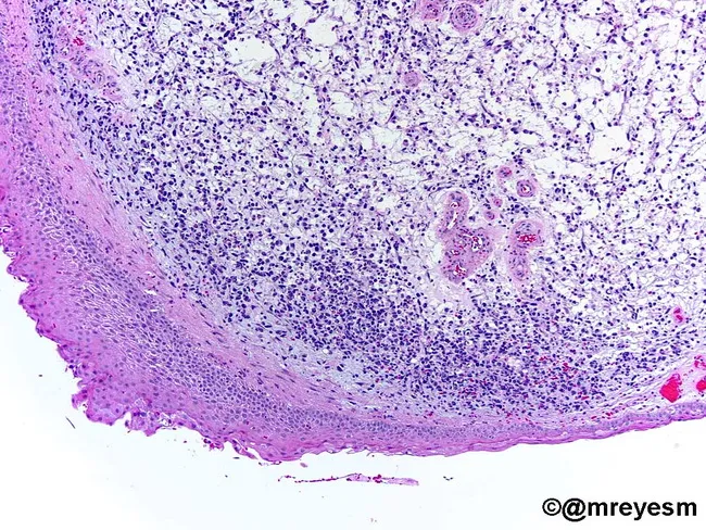 Botryoid Rhabdomyosarcoma : Microscopic