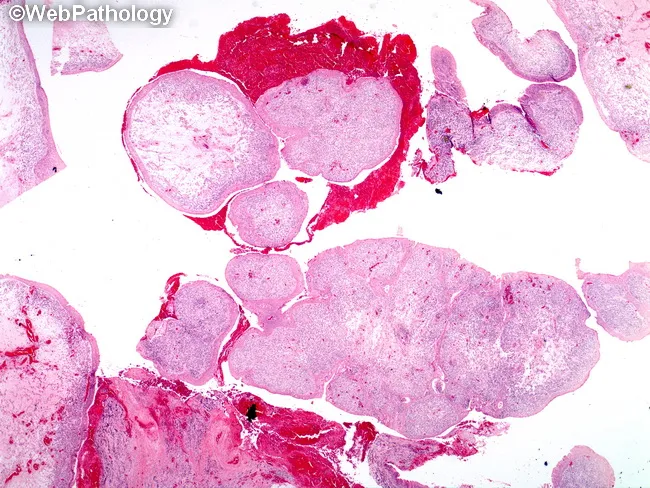 Botryoid Rhabdomyosarcoma