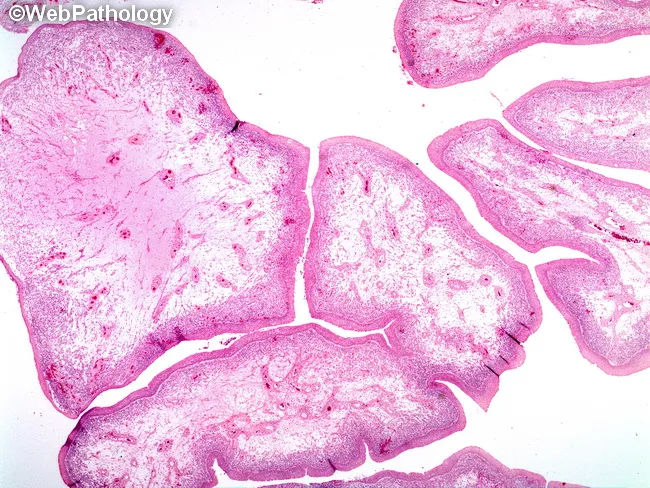 Botryoid Rhabdomyosarcoma