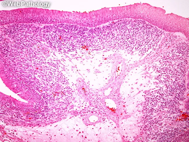 Botryoid Rhabdomyosarcoma